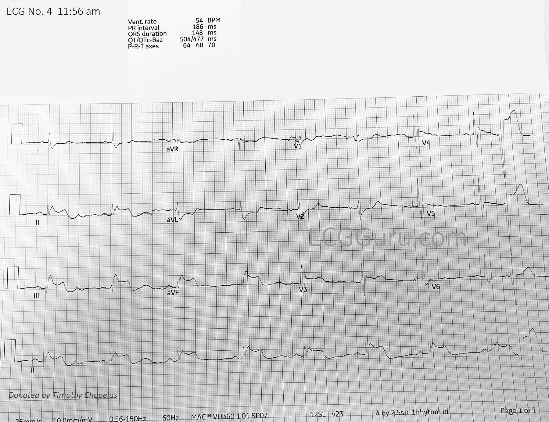 Widespread St Elevation With Right Bundle Branch Block Ecg Guru 9993
